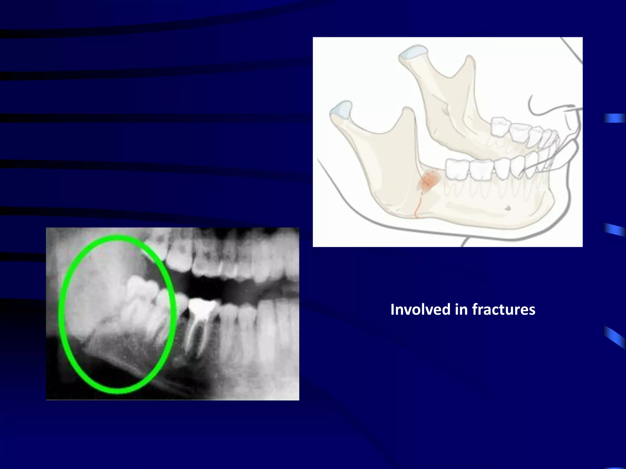 Principles of Exodontia (teeth extraction) by Dr., Giath Gazal, 2020 | PDF