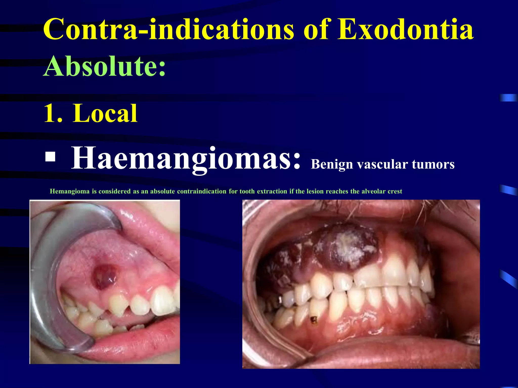 Principles of Exodontia (teeth extraction) by Dr., Giath Gazal, 2020 | PDF