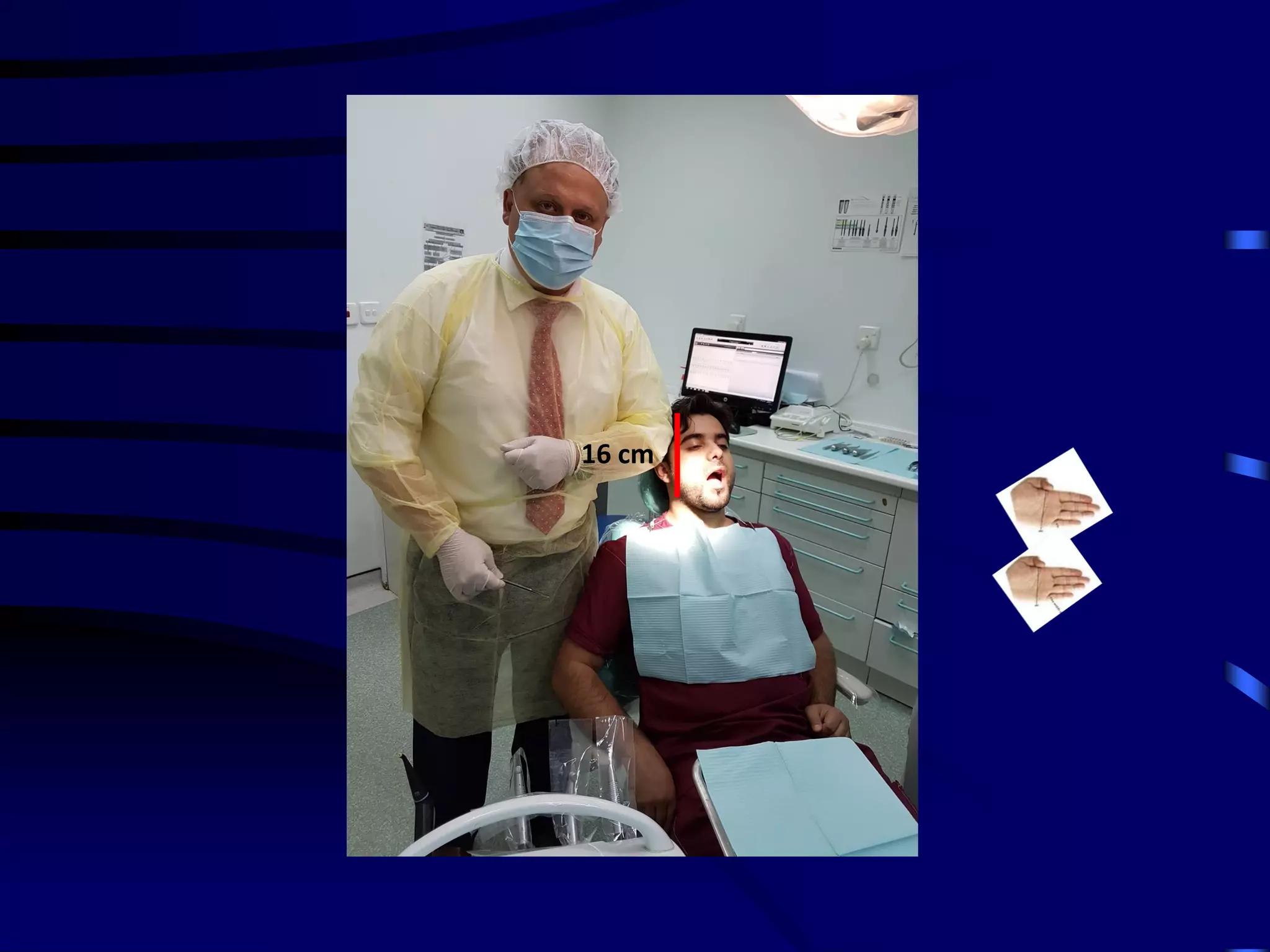 Principles of Exodontia (teeth extraction) by Dr., Giath Gazal, 2020 | PDF