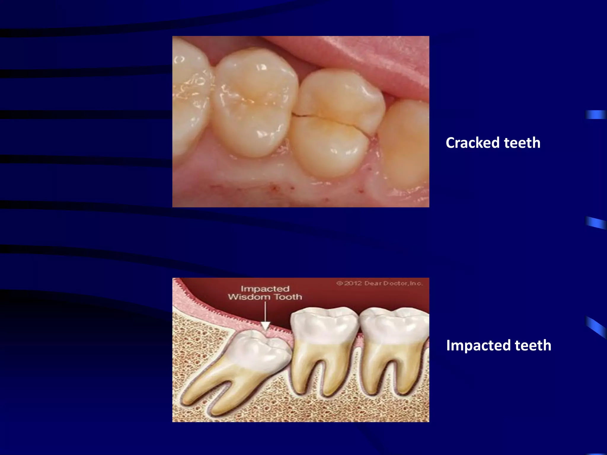 Principles of Exodontia (teeth extraction) by Dr., Giath Gazal, 2020 | PDF