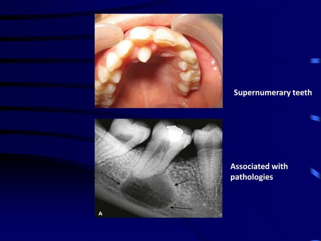 Principles of Exodontia (teeth extraction) by Dr., Giath Gazal, 2020 | PPT