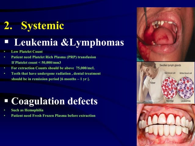 Principles of Exodontia (teeth extraction) by Dr., Giath Gazal, 2020 | PPT