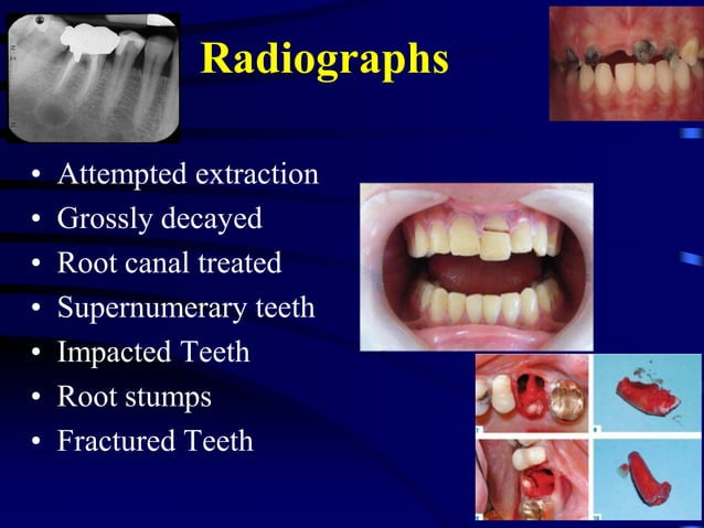 Principles of Exodontia (teeth extraction) by Dr., Giath Gazal, 2020 | PPT