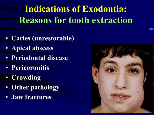 Principles of Exodontia (teeth extraction) by Dr., Giath Gazal, 2020 | PPT
