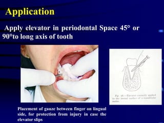 Principles of Exodontia (teeth extraction) by Dr., Giath Gazal, 2020 | PDF