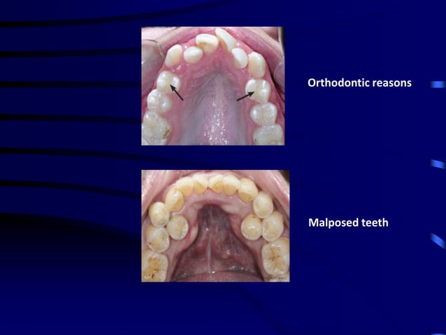 Principles of Exodontia (teeth extraction) by Dr., Giath Gazal, 2020 | PPT