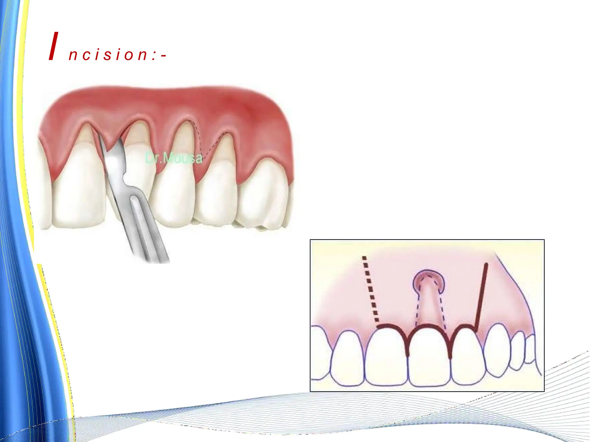 Oral and maxillofacial surgery Exodontia ppt.pptx