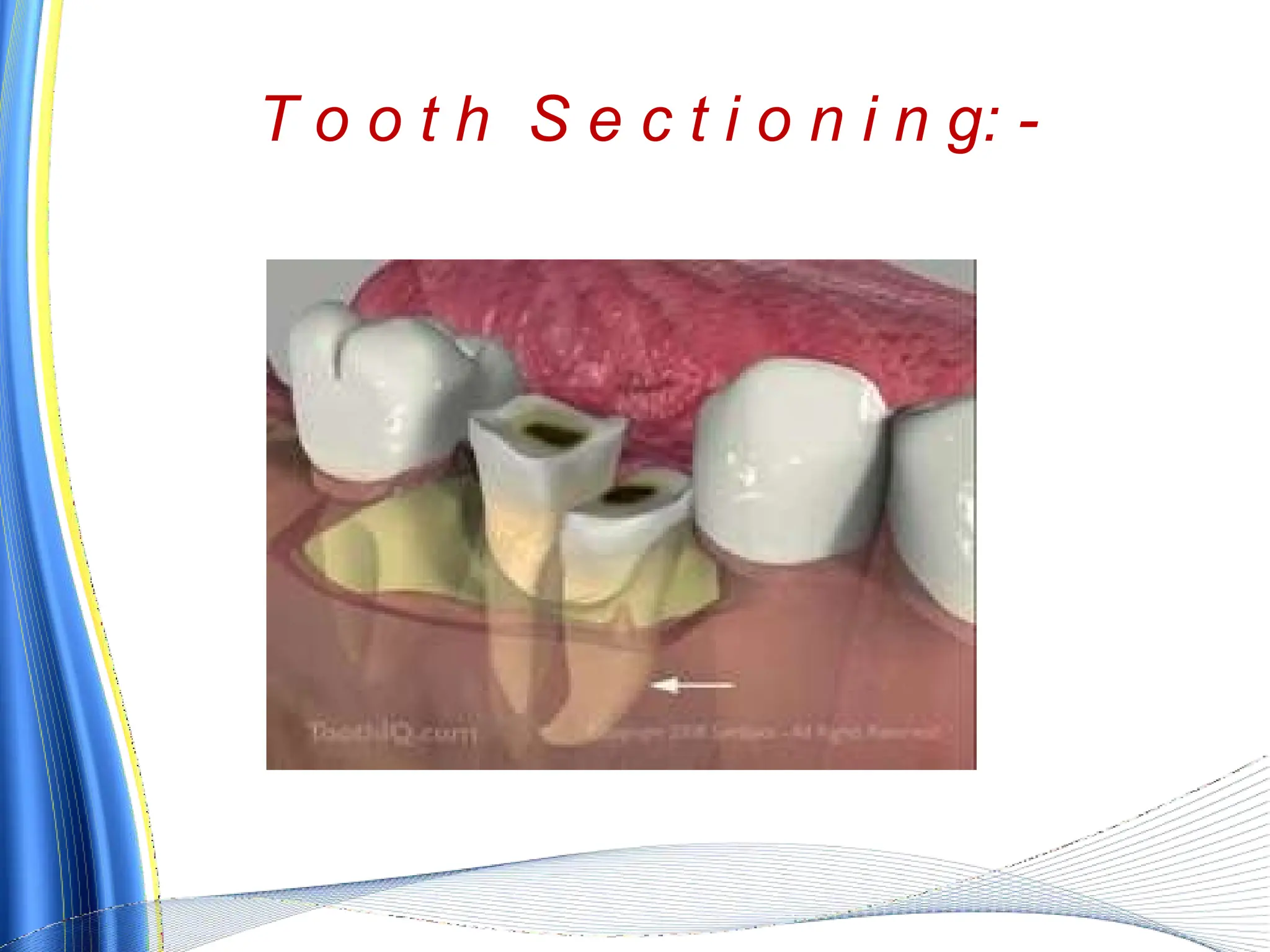 Oral and maxillofacial surgery Exodontia ppt.pptx