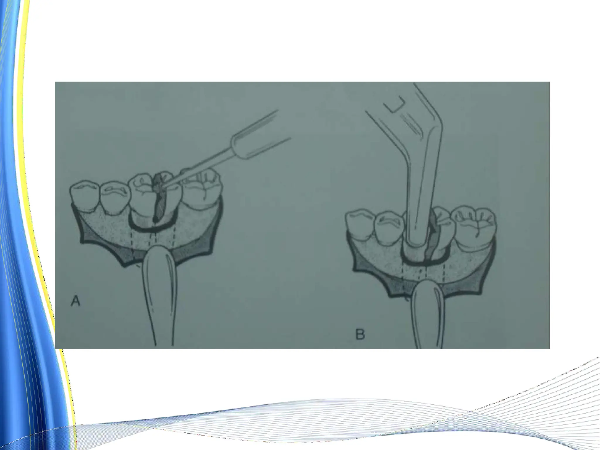 Oral and maxillofacial surgery Exodontia ppt.pptx