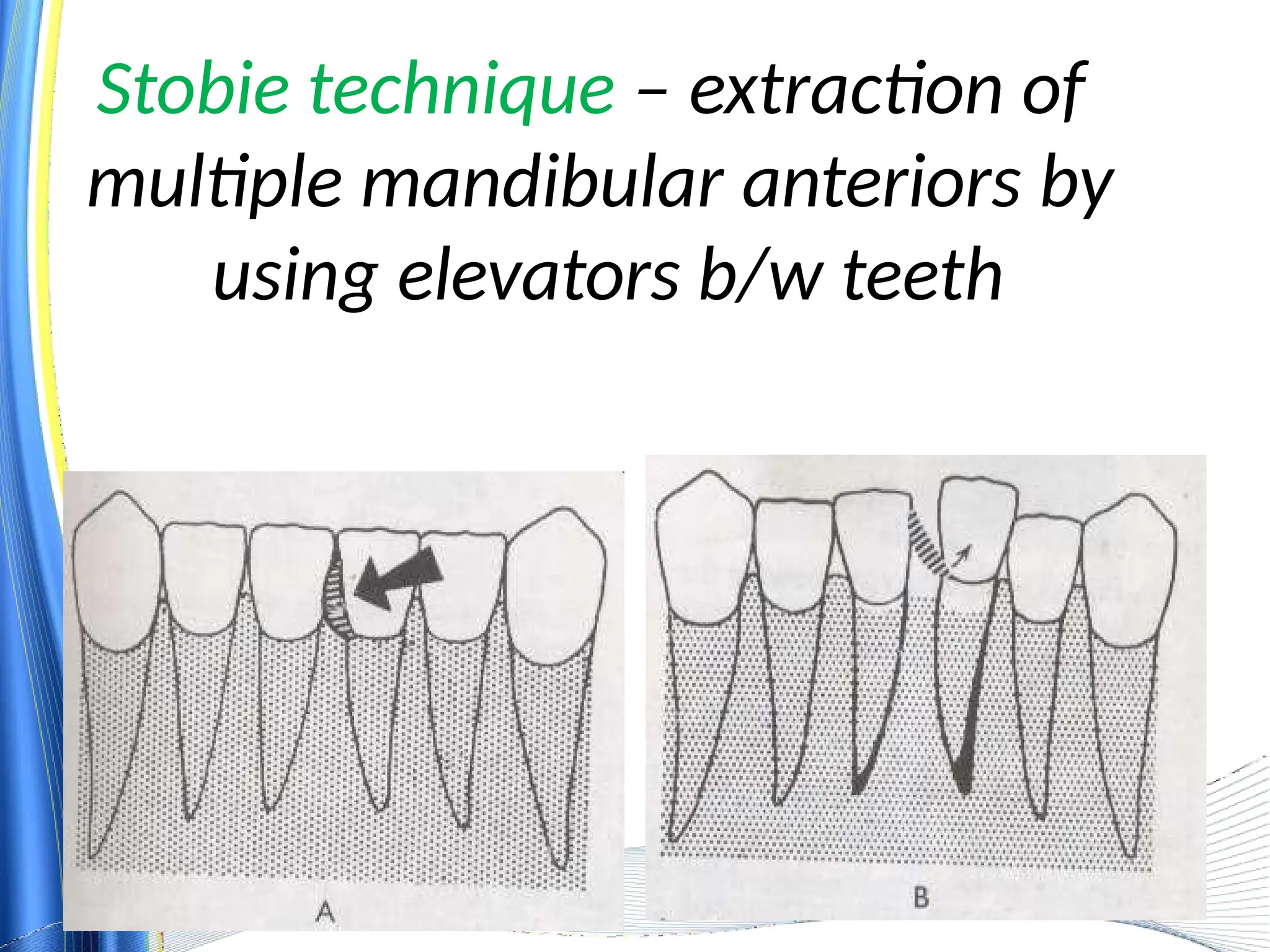 Oral and maxillofacial surgery Exodontia ppt.pptx