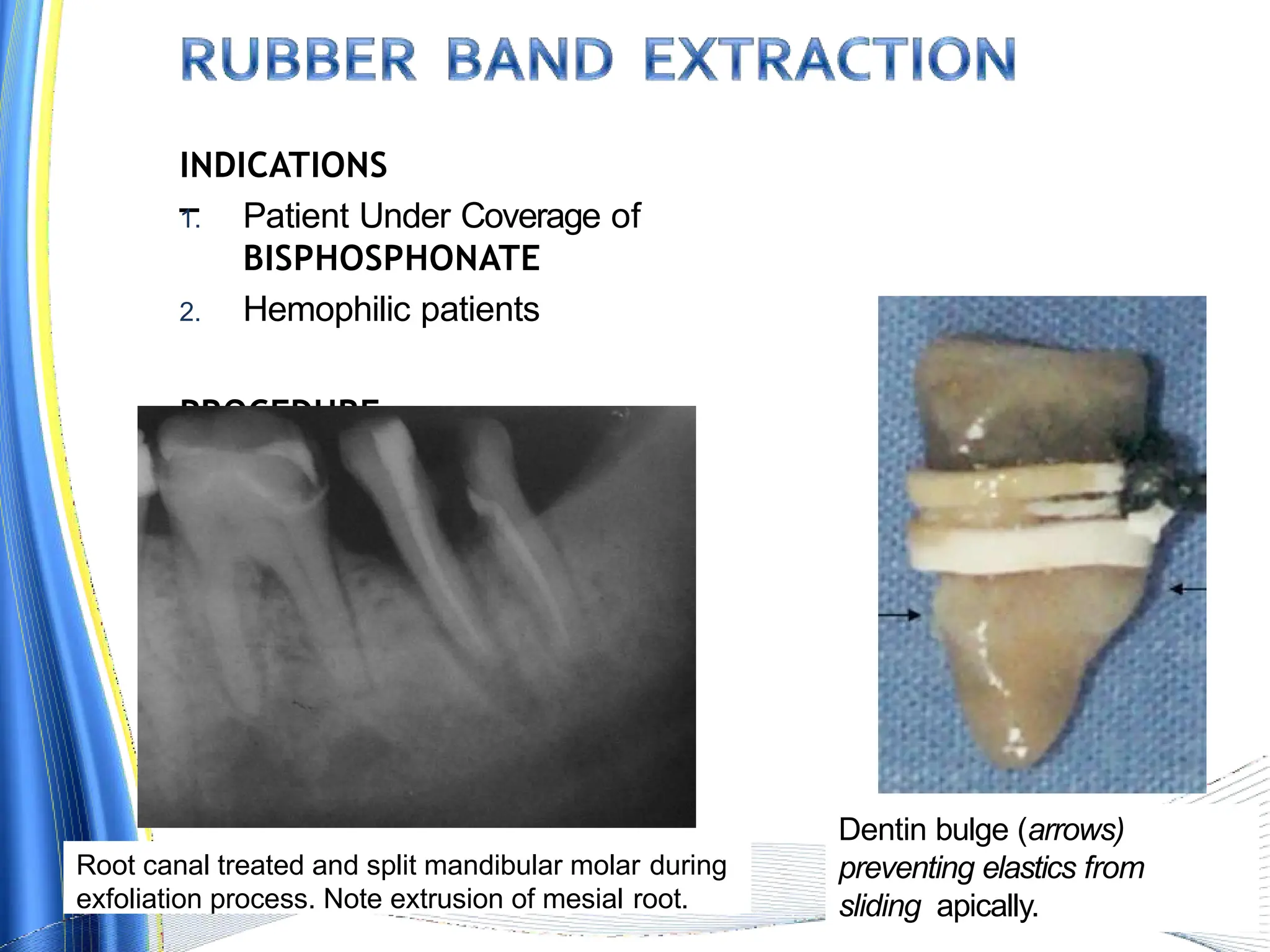 Oral and maxillofacial surgery Exodontia ppt.pptx