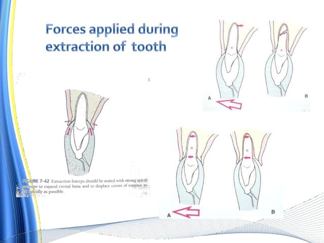 Oral and maxillofacial surgery Exodontia ppt.pptx | Dental Health ...