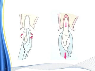 Oral and maxillofacial surgery Exodontia ppt.pptx