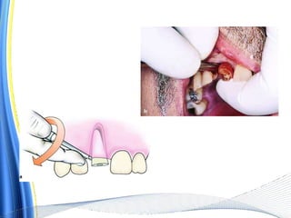 Oral and maxillofacial surgery Exodontia ppt.pptx