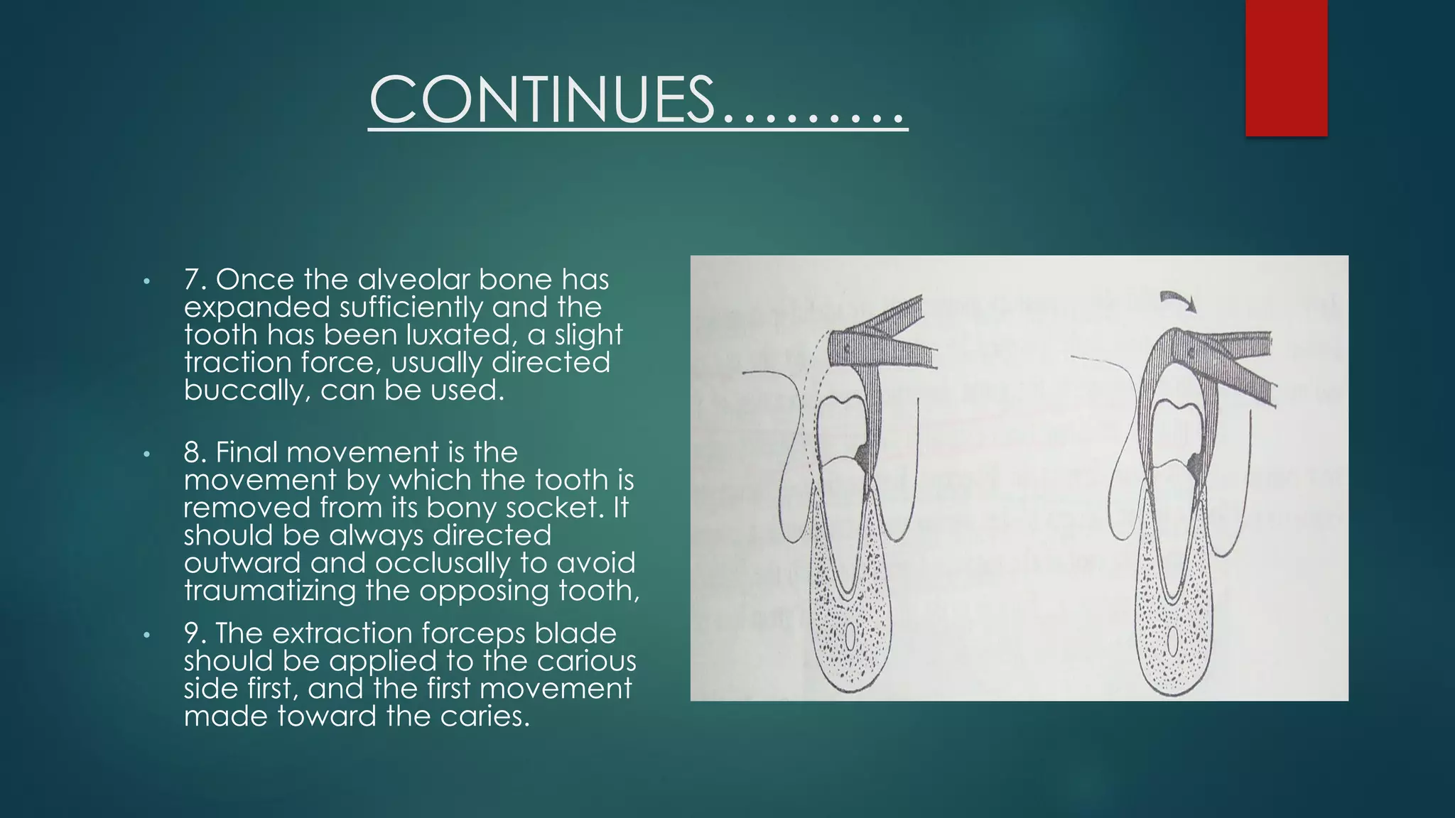 Exodontia Principles and Techniques | PDF