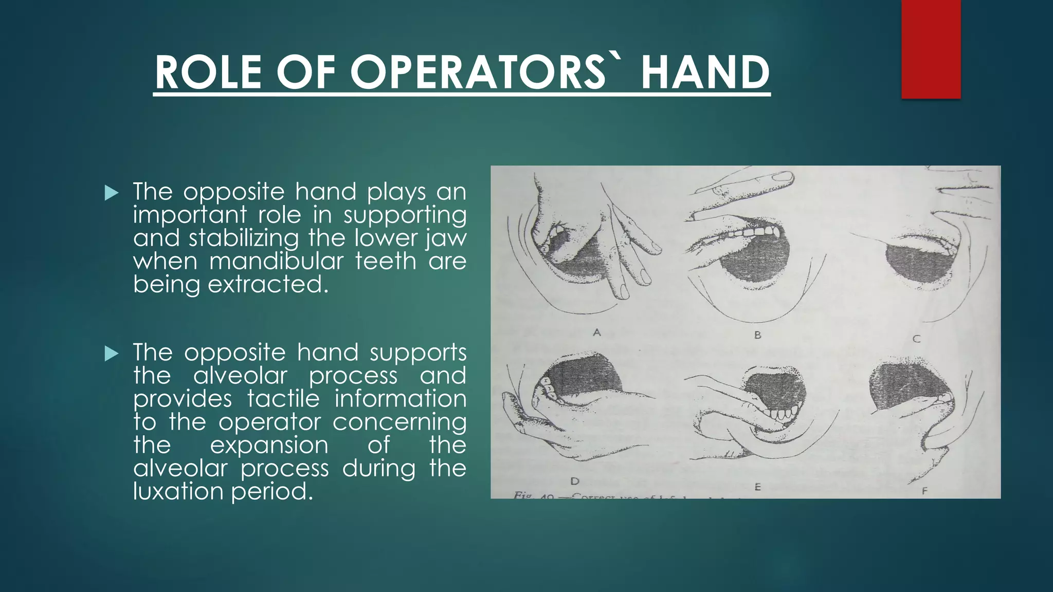 Exodontia Principles and Techniques | PDF