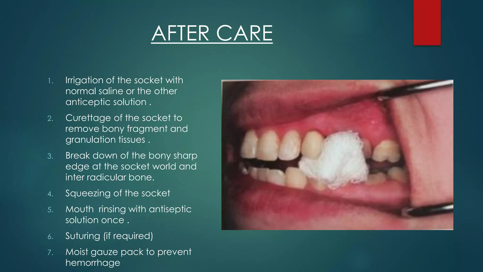 Exodontia Principles and Techniques | PDF