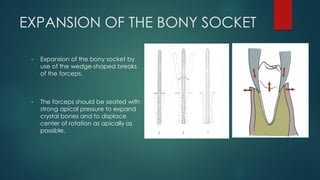 Exodontia Principles and Techniques | PDF