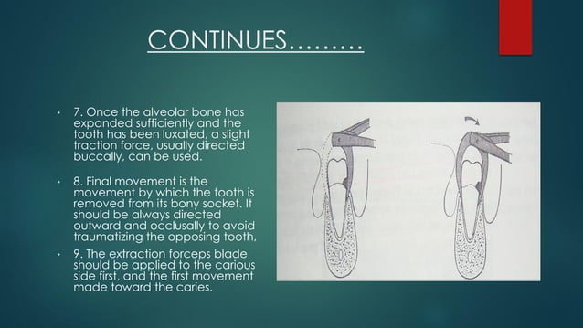 Exodontia Principles and Techniques | PDF | Dental Health | Diseases ...
