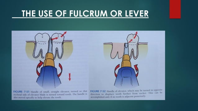Exodontia Principles and Techniques | PDF | Dental Health | Diseases ...