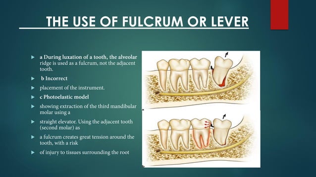 Exodontia Principles and Techniques | PDF | Dental Health | Diseases ...