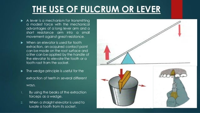 Exodontia Principles and Techniques