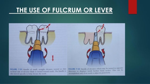 Exodontia Principles and Techniques
