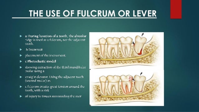 Exodontia Principles and Techniques