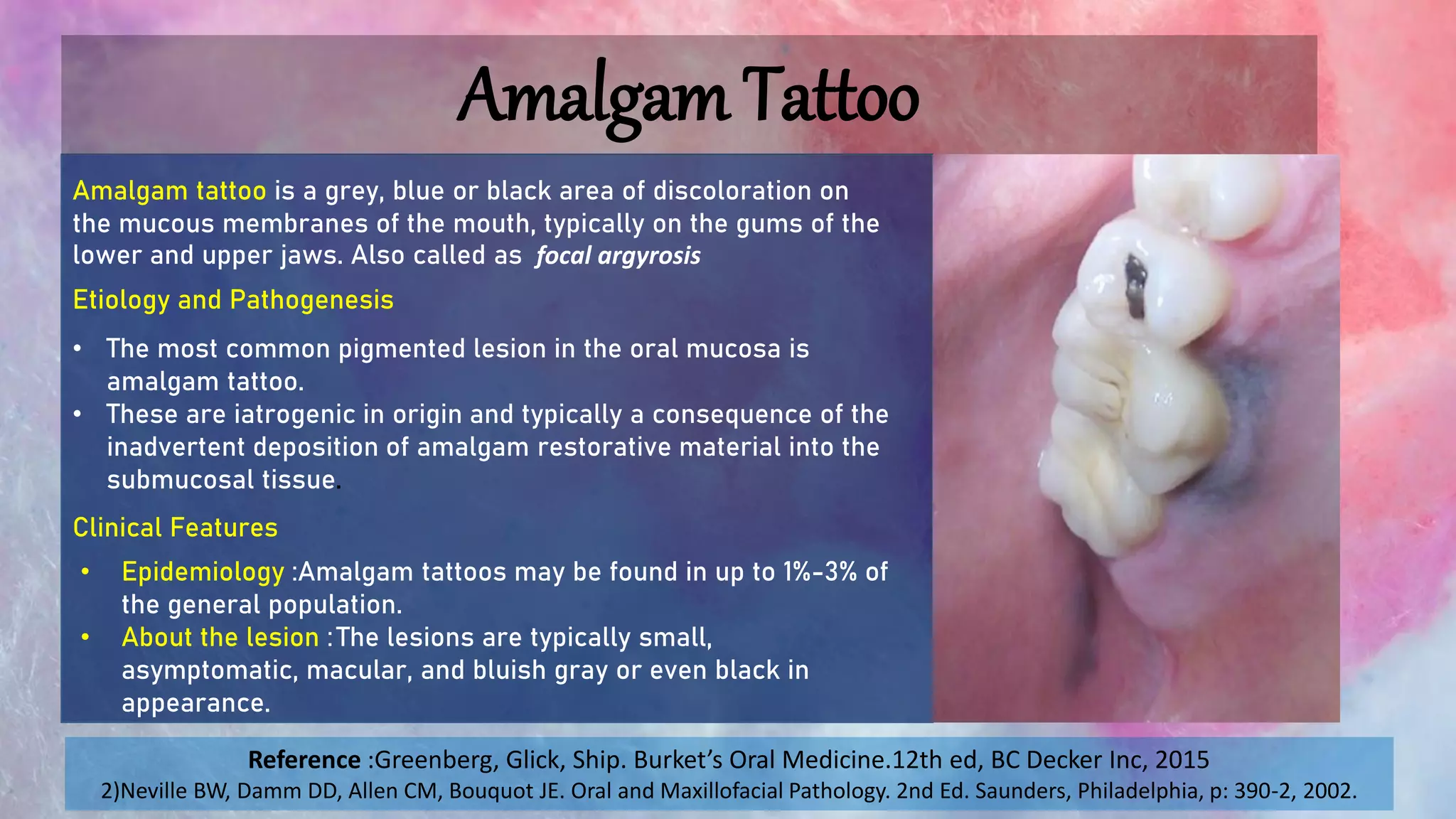 Exogenous Pigmentation of Oral Mucosa | PDF