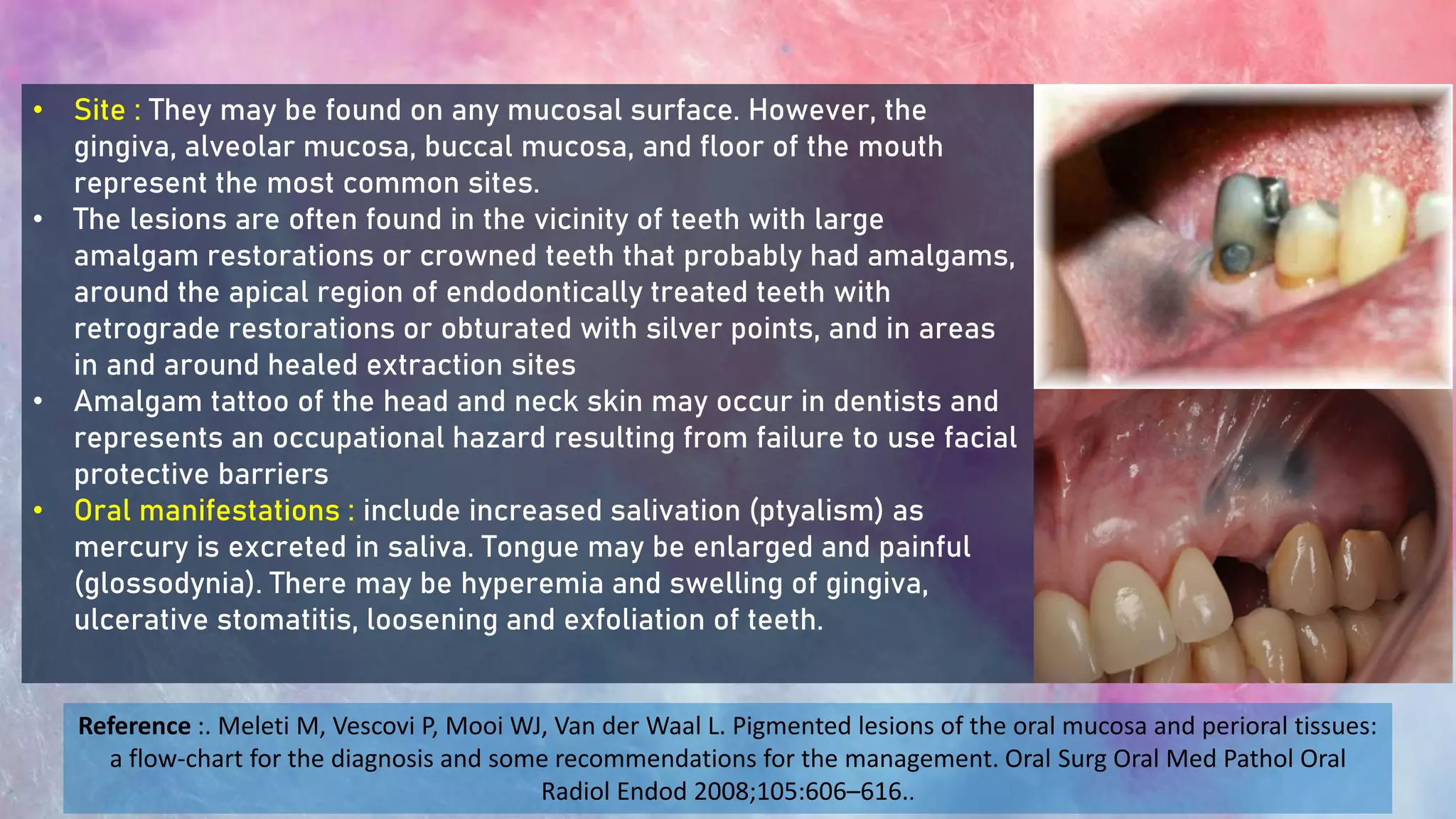 Exogenous Pigmentation of Oral Mucosa | PDF