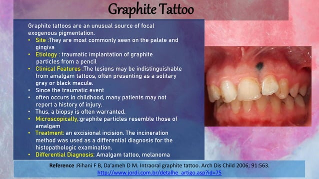 Exogenous Pigmentation of Oral Mucosa | PDF | Dental Health | Diseases ...