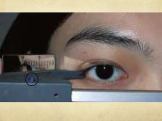 Exophthalmometry | PPTX