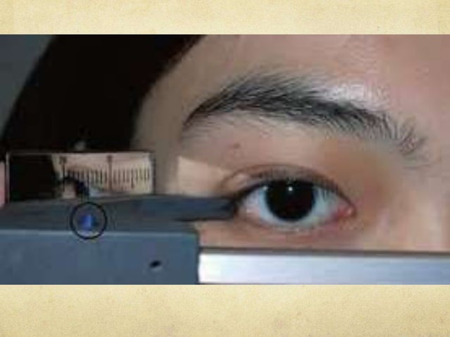 Exophthalmometry | PPTX | Ear, Nose and Throat Conditions | Diseases ...