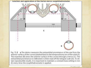 Exophthalmometry | PPT