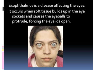 Exophthalmos | PPT
