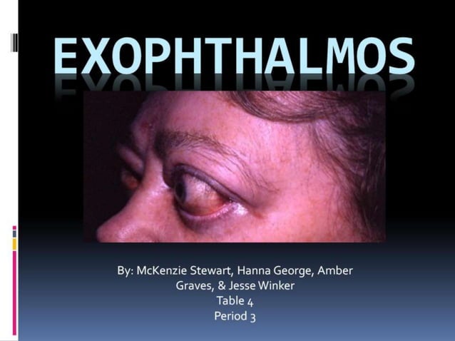 Exophthalmos | PPT