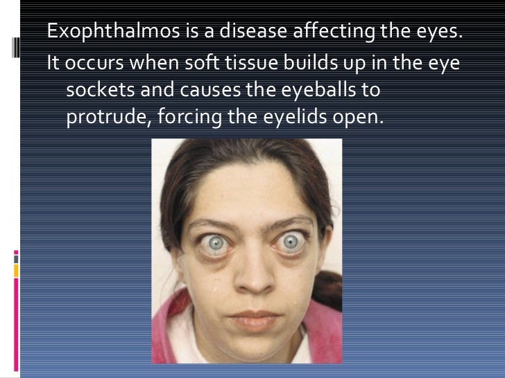 Exophthalmos 120207085829-phpapp02[1][1]