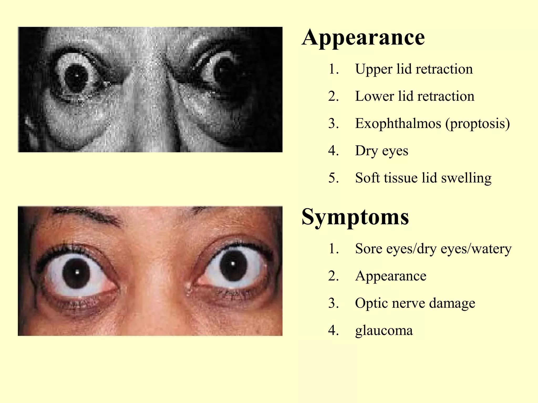 Exophthalmos, thyroid eye disease. | PPT | Thyroid Disorders ...