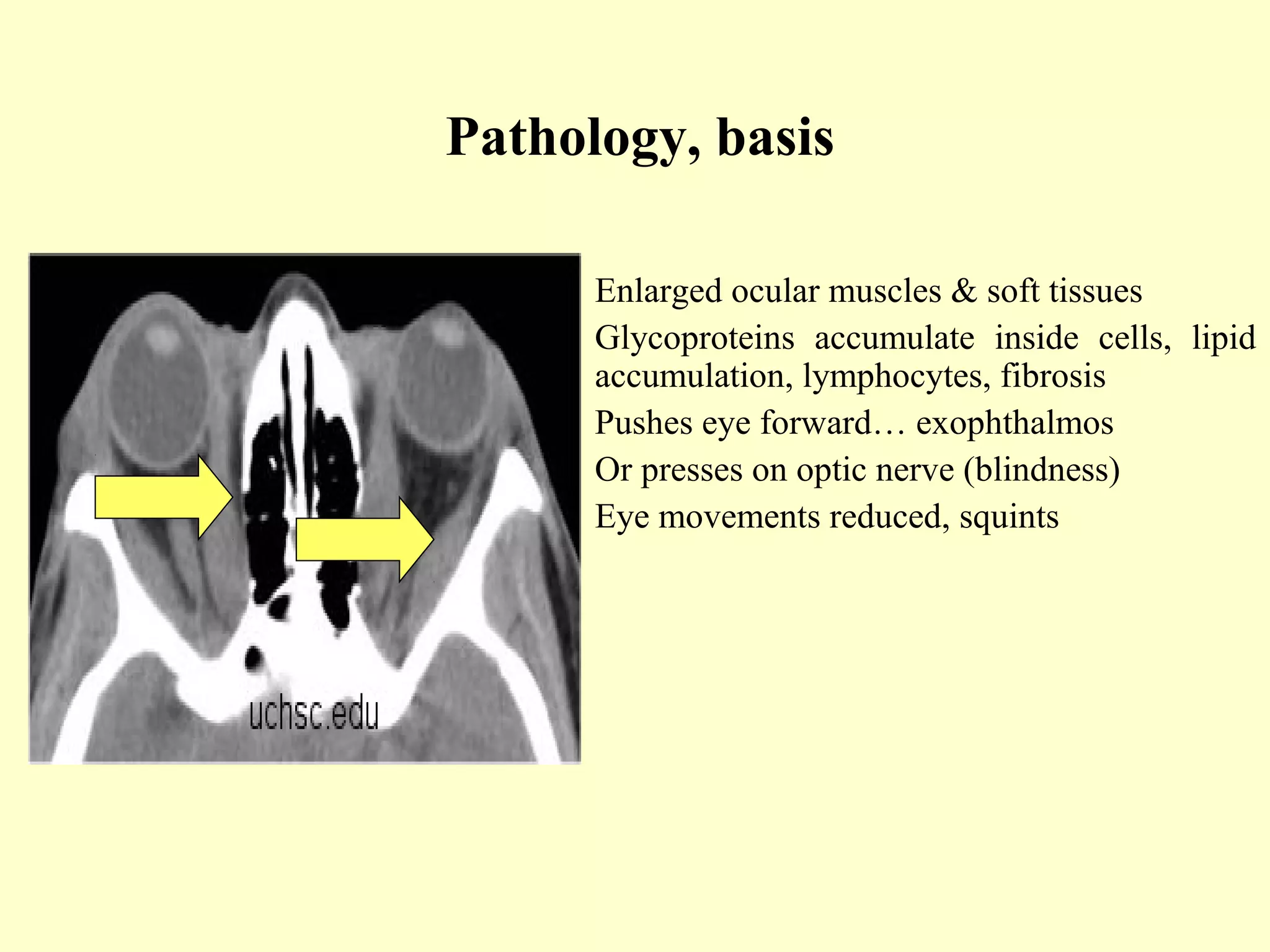 Exophthalmos, thyroid eye disease. | PPT | Thyroid Disorders ...