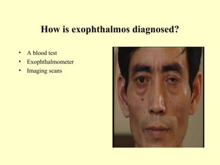 Exophthalmos, thyroid eye disease. | PPT | Thyroid Disorders ...
