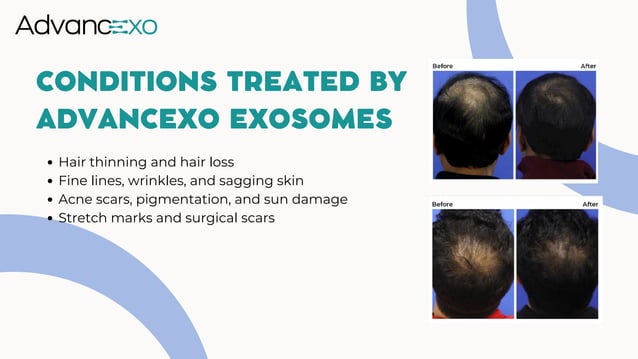 Exosomes in Aesthetics: Revolutionary Treatments for Hair & Skin ...
