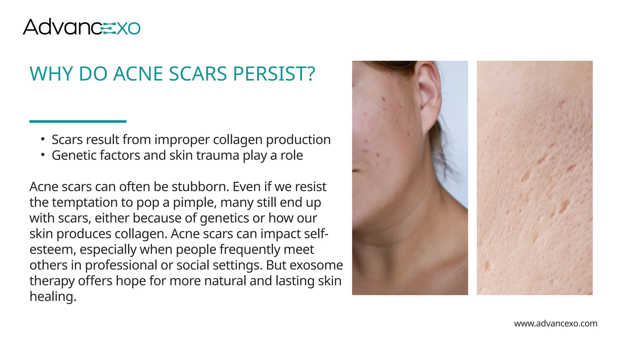Exosome Therapy for Acne Scars, Lines, and Wrinkles | PPT