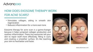 Exosome Therapy for Acne Scars, Lines, and Wrinkles | PPT