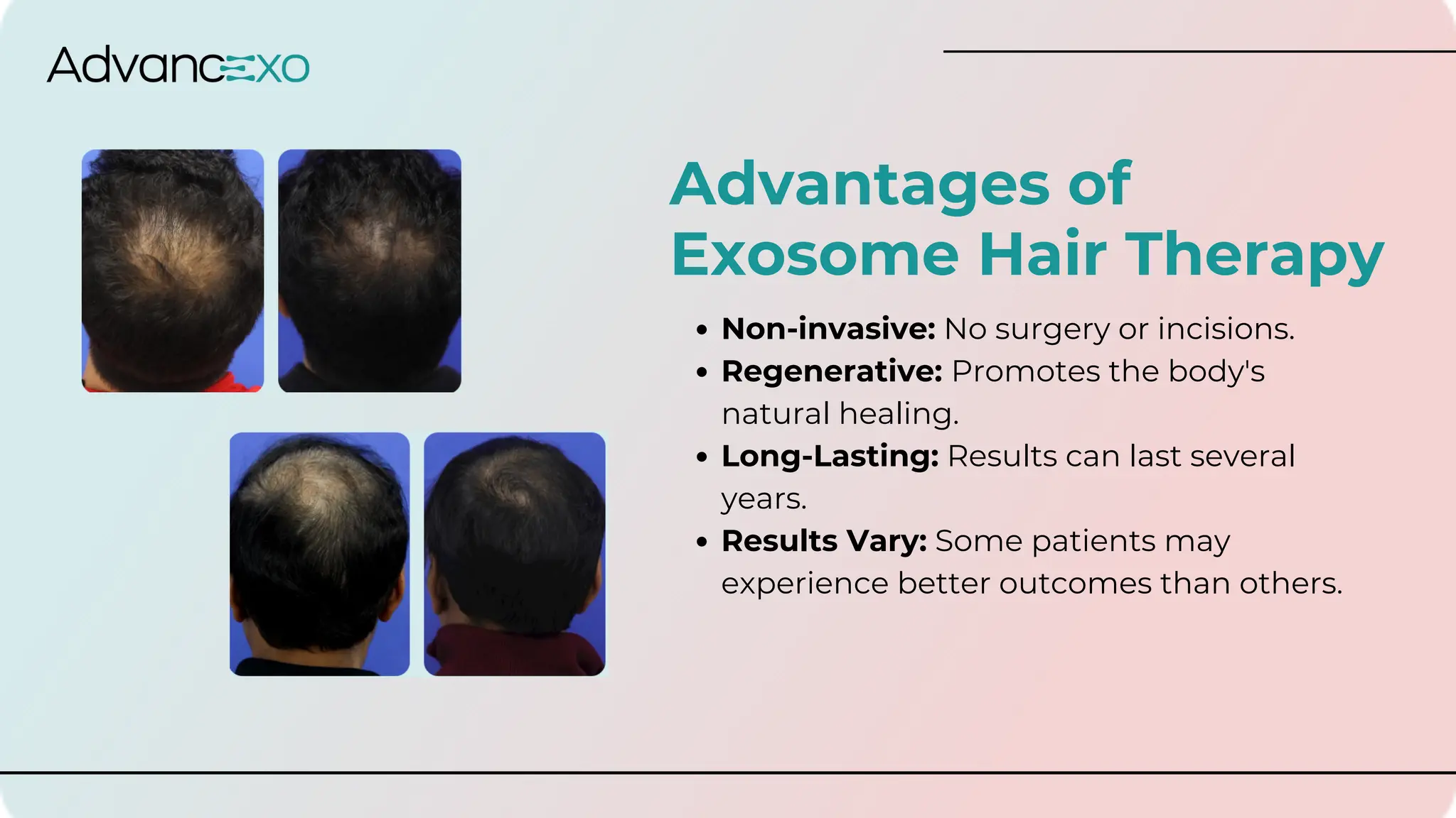 Exosome Therapy for Hair Loss: Revolutionizing Hair Treatment | PDF