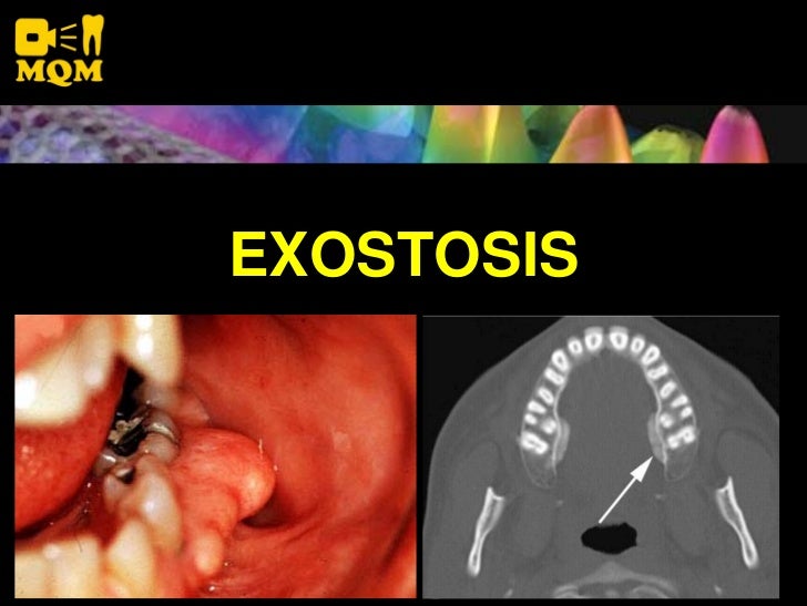 Exostosis Dental