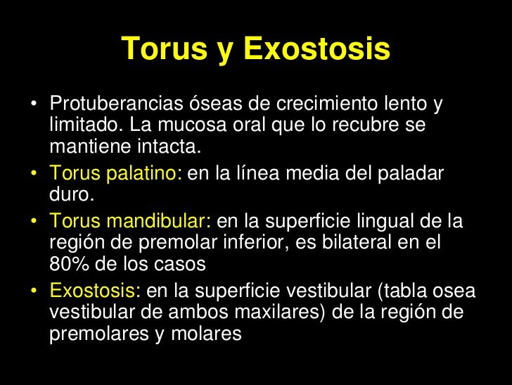 Exostosis Dental