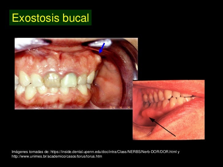 Exostosis Dental