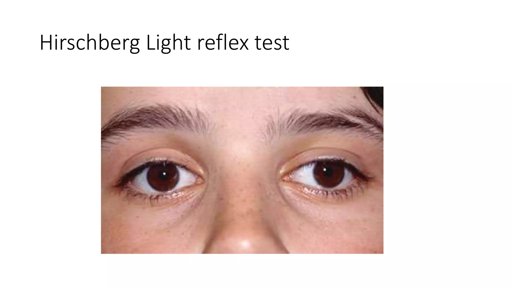 Exotropia | PPTX