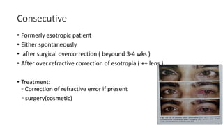 Exotropia | PPTX