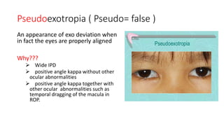 Exotropia | PPTX